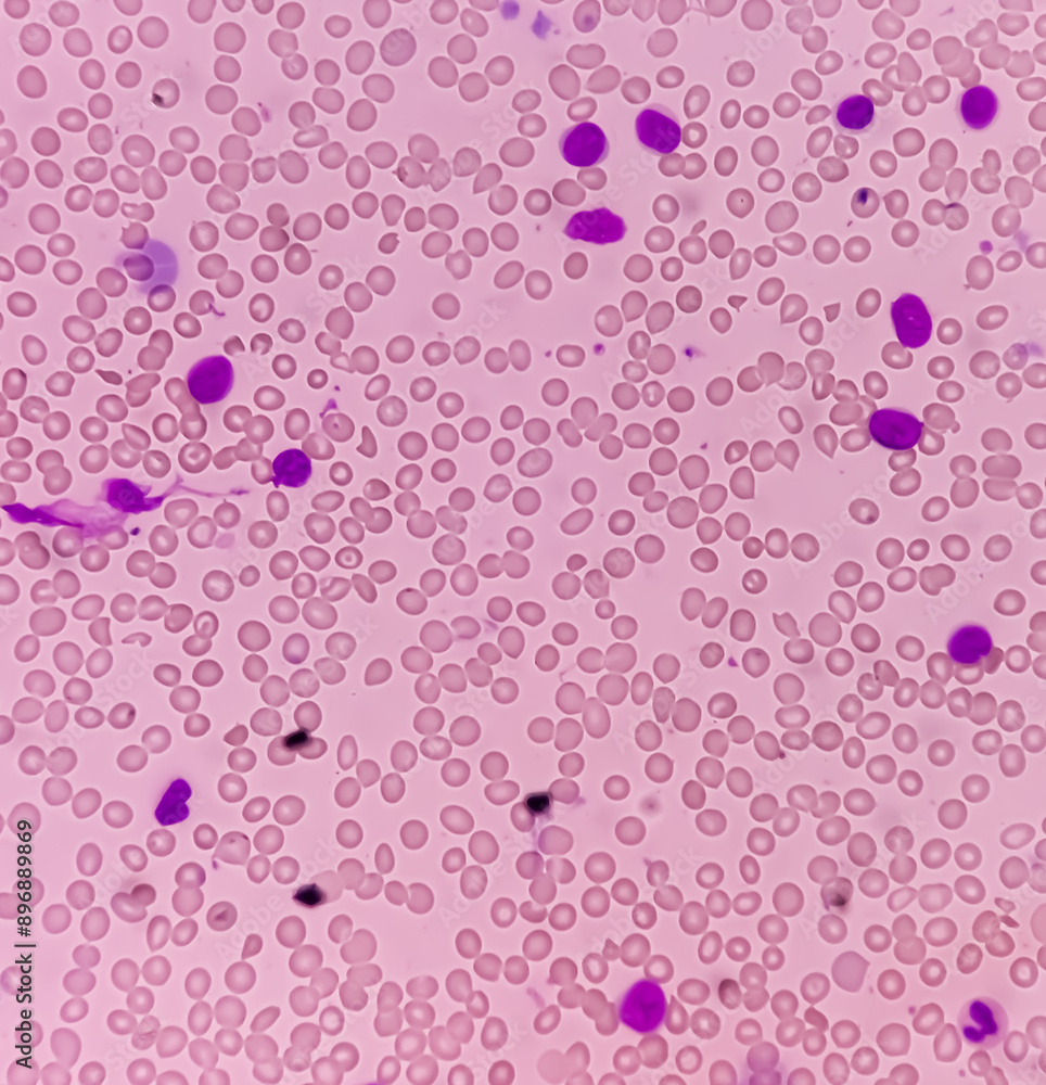 Bone marrow study smear picture of Acute Myeloid Leukemia, Blast cell, Granulopoiesis ...