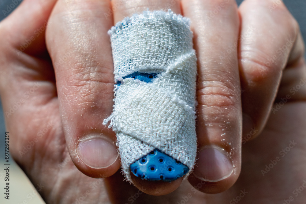 Mallet finger with custom orthosis on the middle finger to immobilize ...