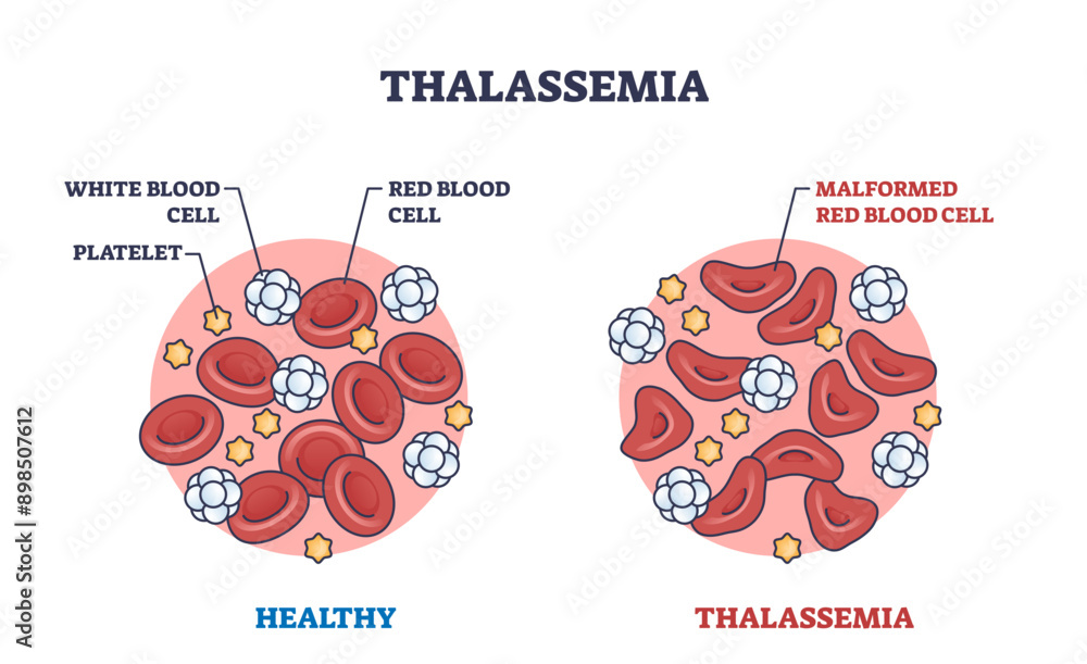 Thalassemia blood disorder caused by lack of hemoglobin outline diagram ...
