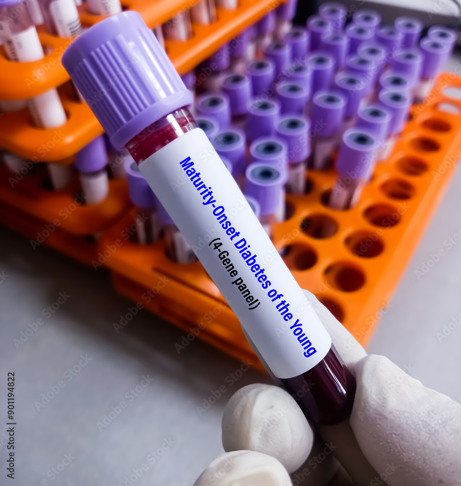 Blood sample for MODY or Maturity-Onset Diabetes of the Young test to ...