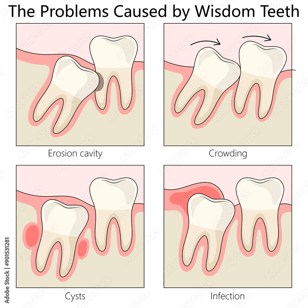issues caused by wisdom teeth. Highlights dental problems and the need ...