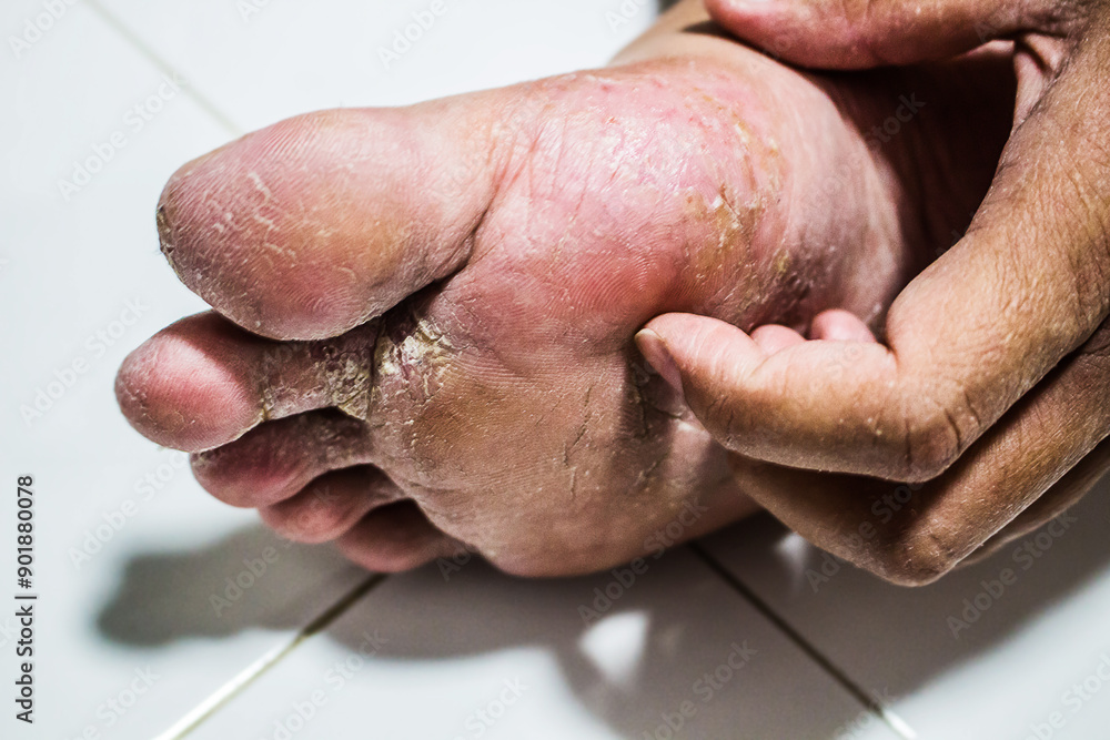 Men's feet with fungus, The skin peels off into wounds, Athlete's Foot ...