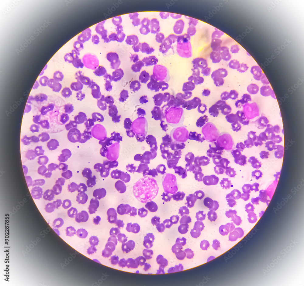 Acute leukemia, ALL(Acute lymphoblastic leukemia), peripheral blood ...