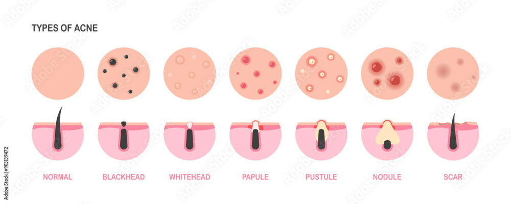 Stages of acne development. Acne of types and skin disease: skin ...