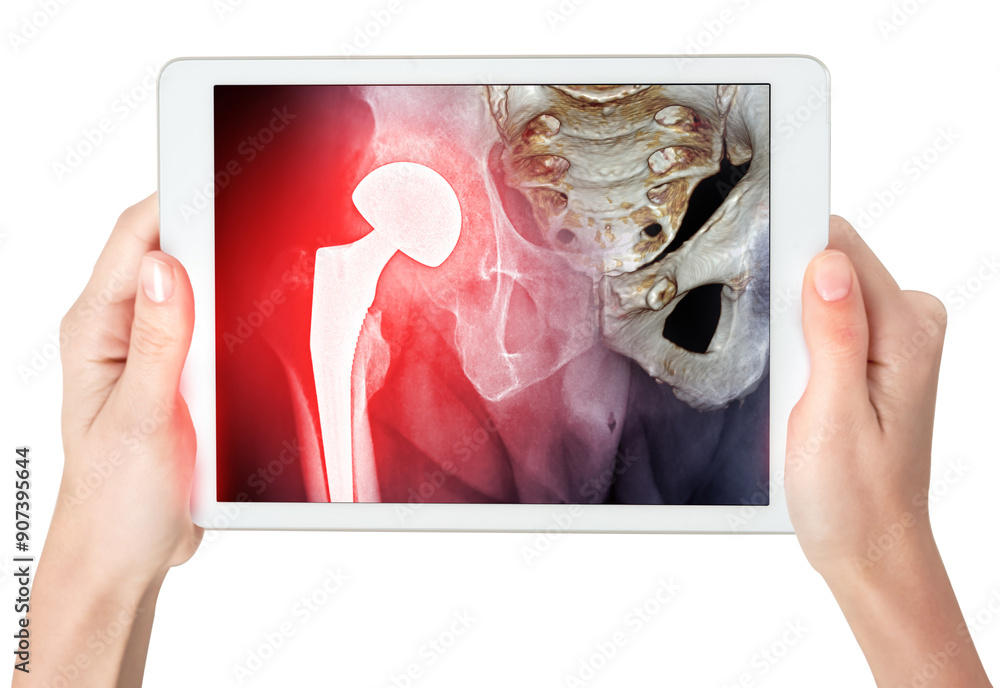 A tablet screen with A x-ray Right Hip joint ap view showing Right hip ...