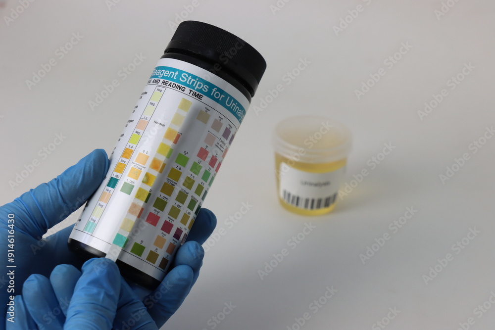 Professional holding the reagent strips for urinalysis and the reading ...