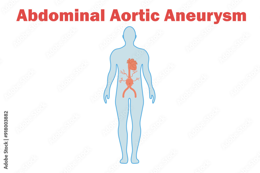 Image vectorielle Stock An abdominal aortic aneurysm is a bulging ...