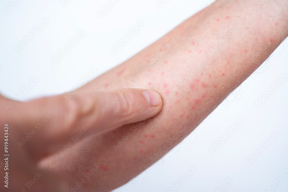 Foto de Stock male hand with red skin rash, itchy skin, allergic ...
