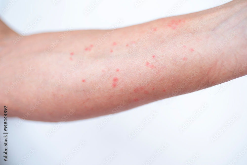male hand with red skin rash, itchy skin, allergic response, Hives ...