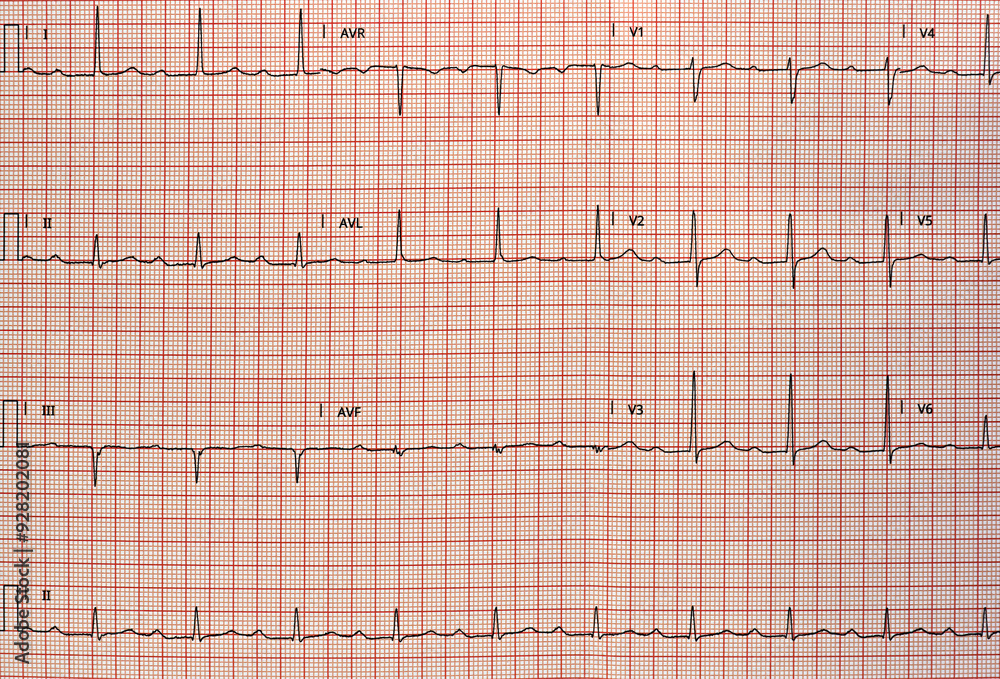 Electrocardiogram in paper form. Analog electrocardiographic recording ...