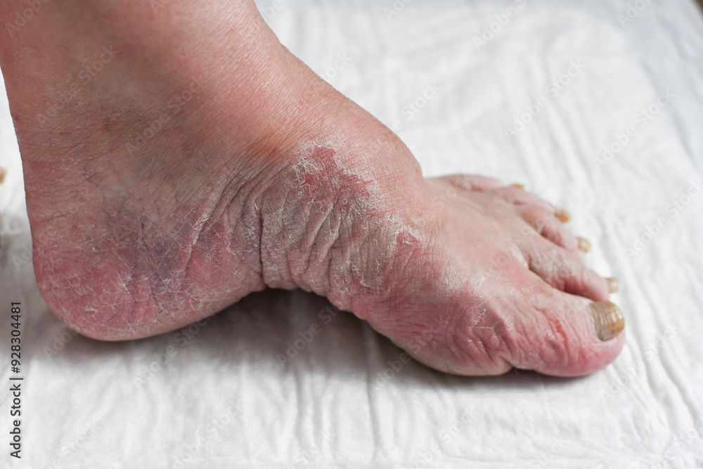 Skin damage, a wound on a woman's legs. Diseases of the skin. Damage to ...
