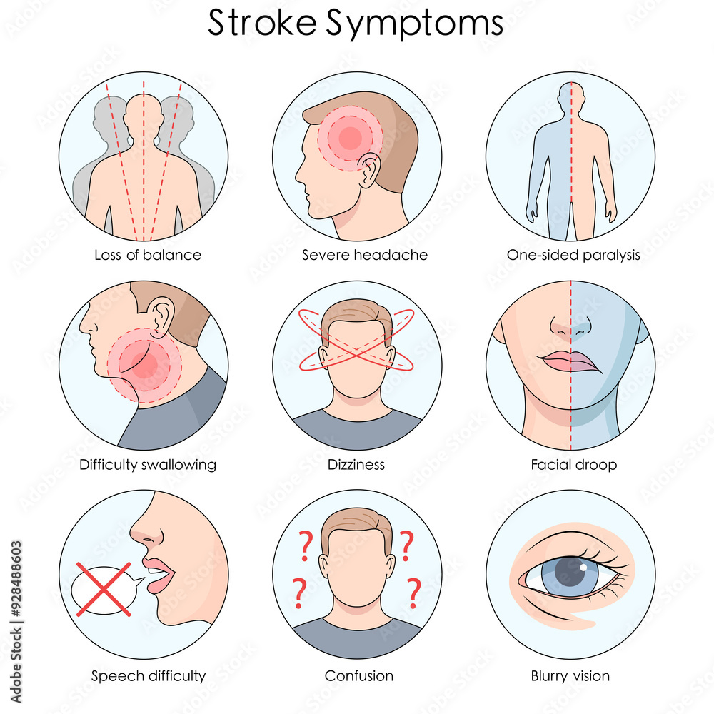common stroke symptoms, dizziness, severe headache, facial droop ...