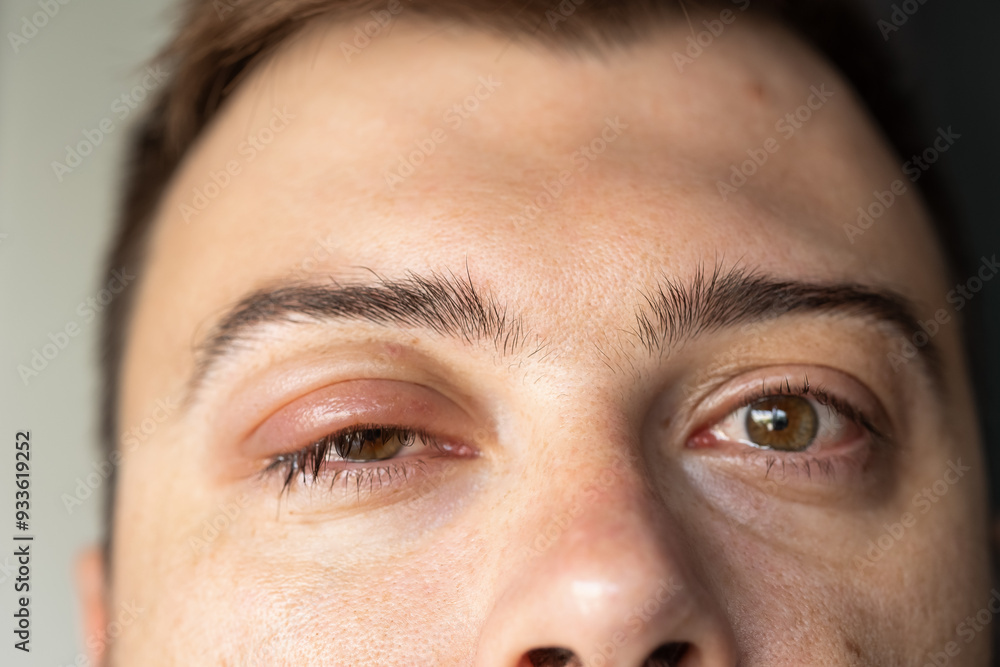 inflamed eye gives idea visible symptoms of bacterial eye infections ...