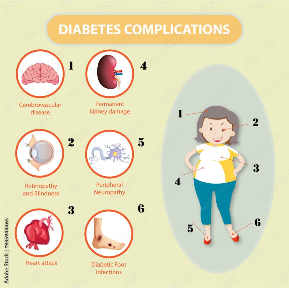 Diabetes complications information infographic Stock Vector | Adobe Stock
