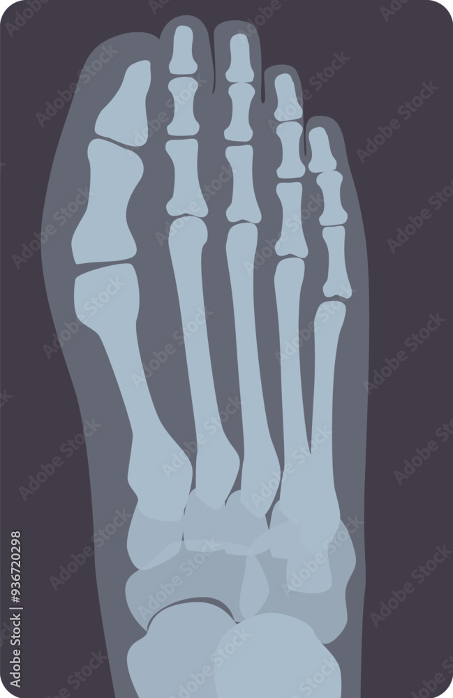 Superior radiograph of human right foot or limb. X-ray picture or ...