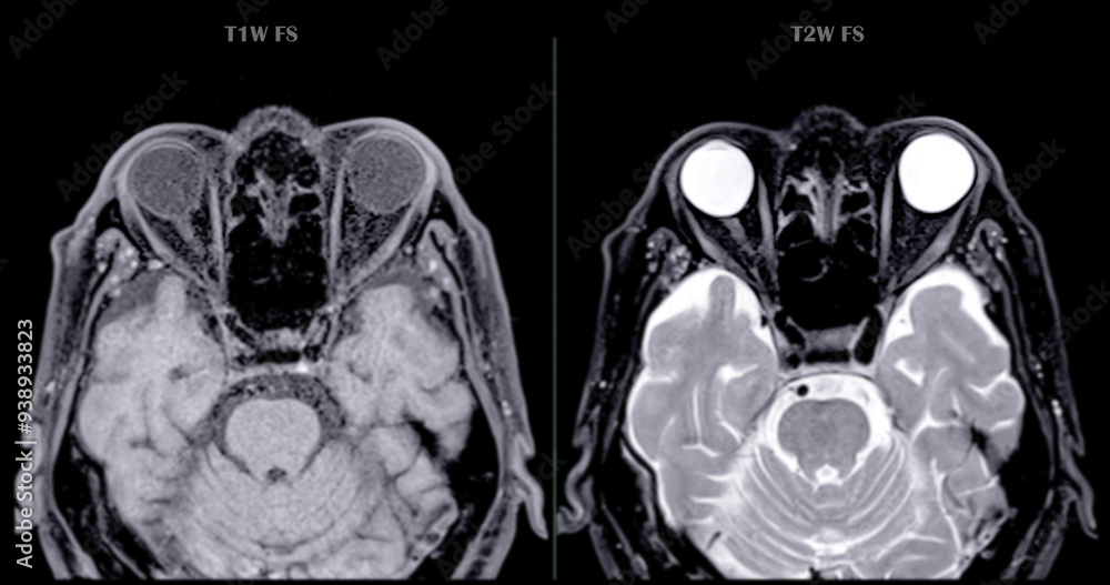Ilustração do Stock Image of MRI orbit scan with gadolinium contrast in ...