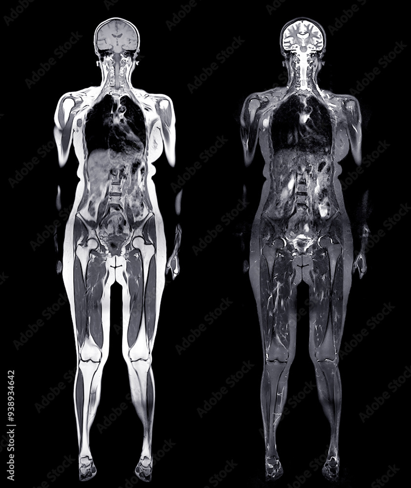 MRI whole body scans are beneficial for early cancer detection ...