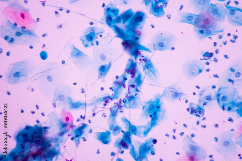 View in microscopic of Candidiasis, fungus infection (Yeast and ...
