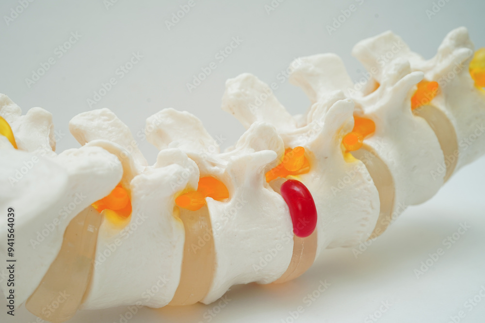 Spinal nerve and bone, Lumbar spine displaced herniated disc fragment ...
