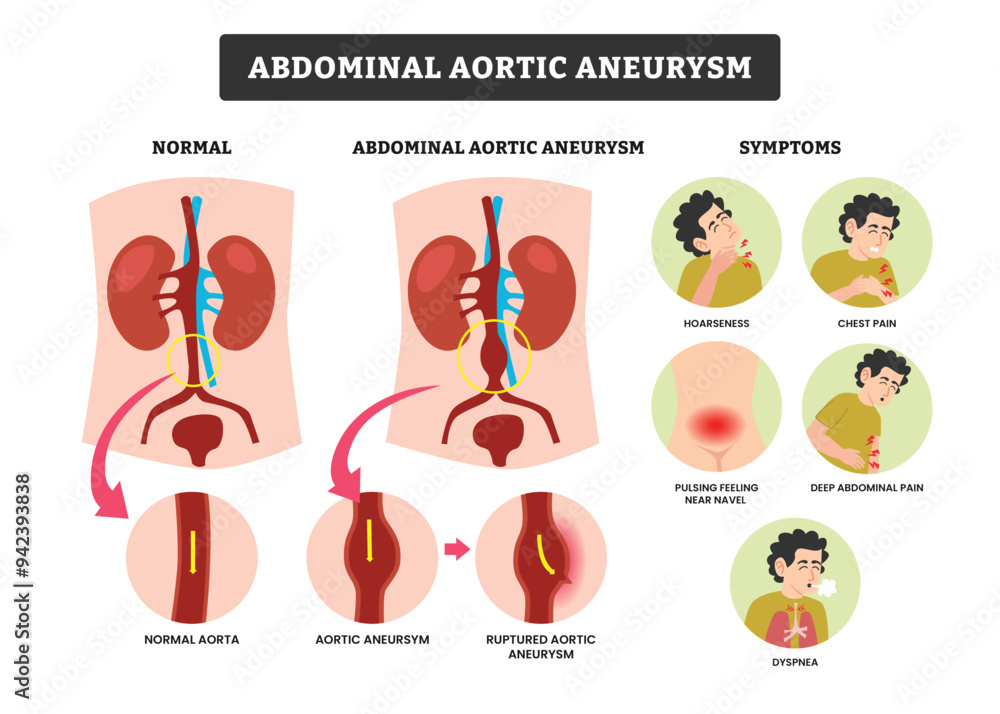 Abdominal Aortic Aneurysm with symptoms medical poster infographic, Thoracic and Abdominal ...