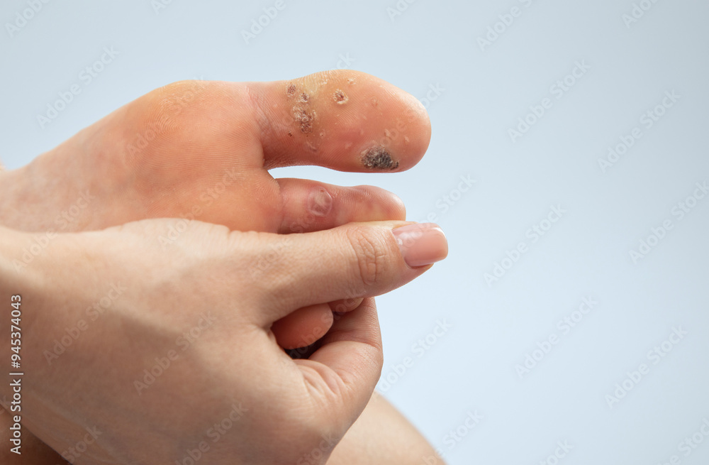 Girl applying ointment to a wart on her toe. Treatment of plantar warts ...