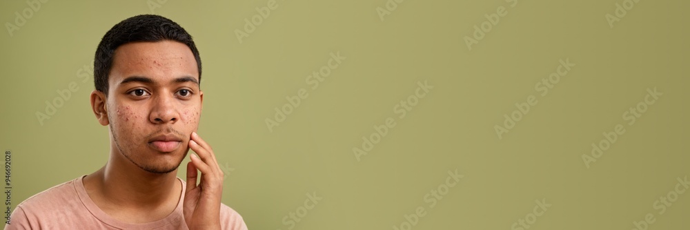Young polynesian man scratched face with skin problems. Red spots on ...