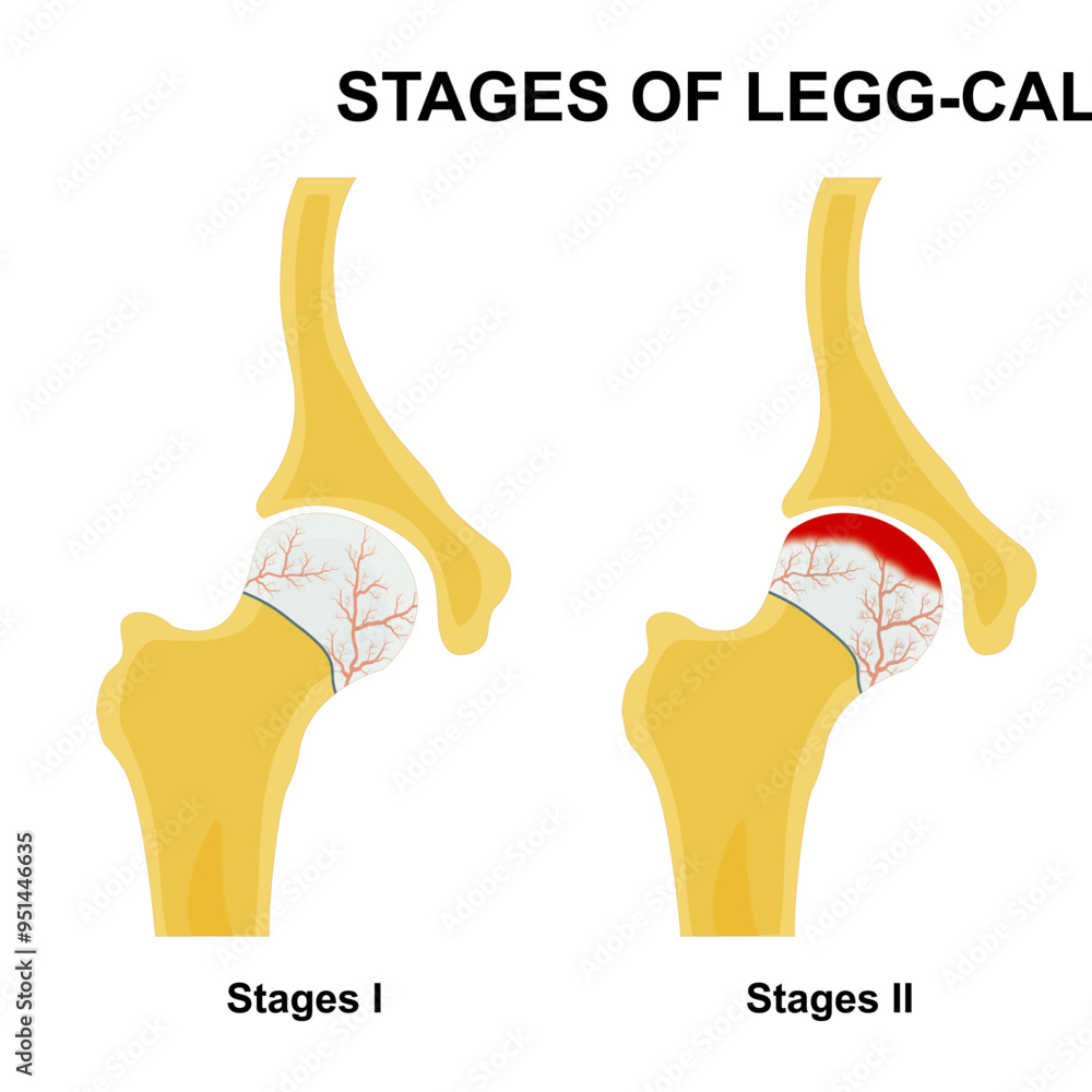 Stages of Legg Calve Perthes Disease Stock Vector | Adobe Stock