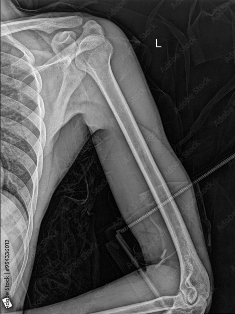 Normal Humerus X-ray Displaying Anatomically Intact Humeral Shaft and ...