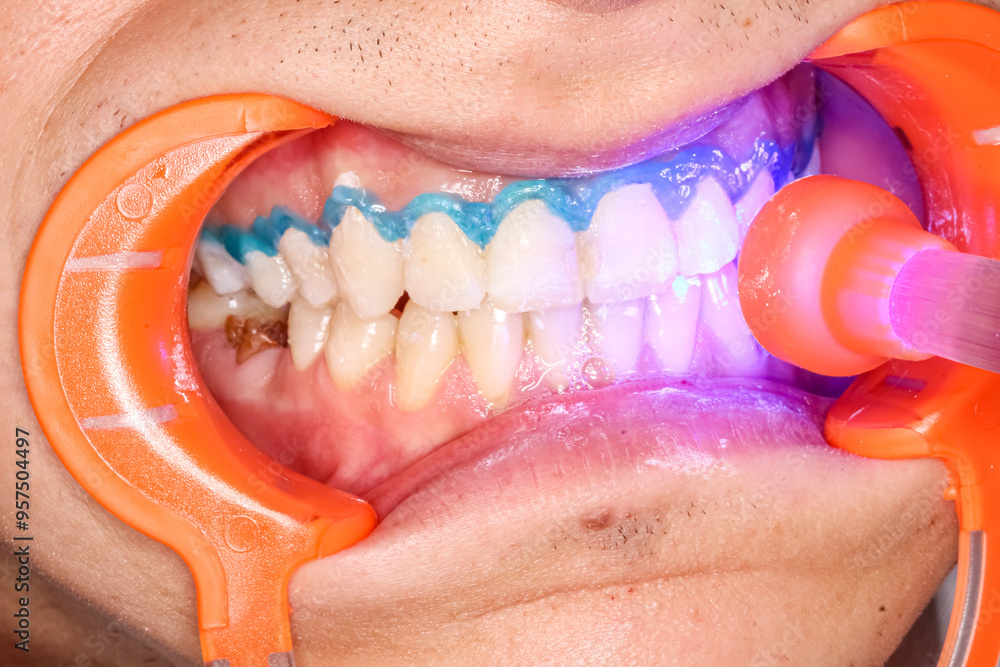 A blue gel applied on the neck of the upper teeth to protect the ...