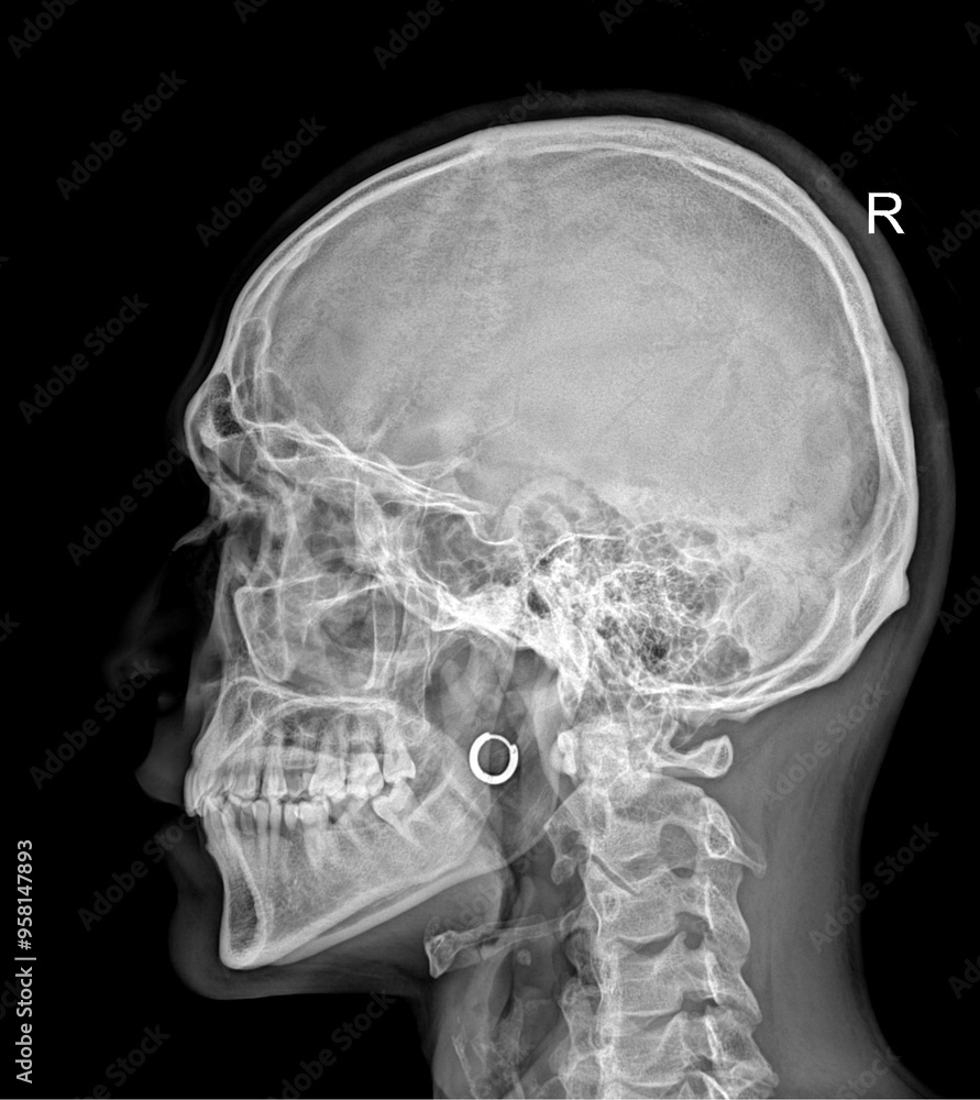 Lateral Skull X-Ray: A Radiographic Window into Cranial Structure Stock ...
