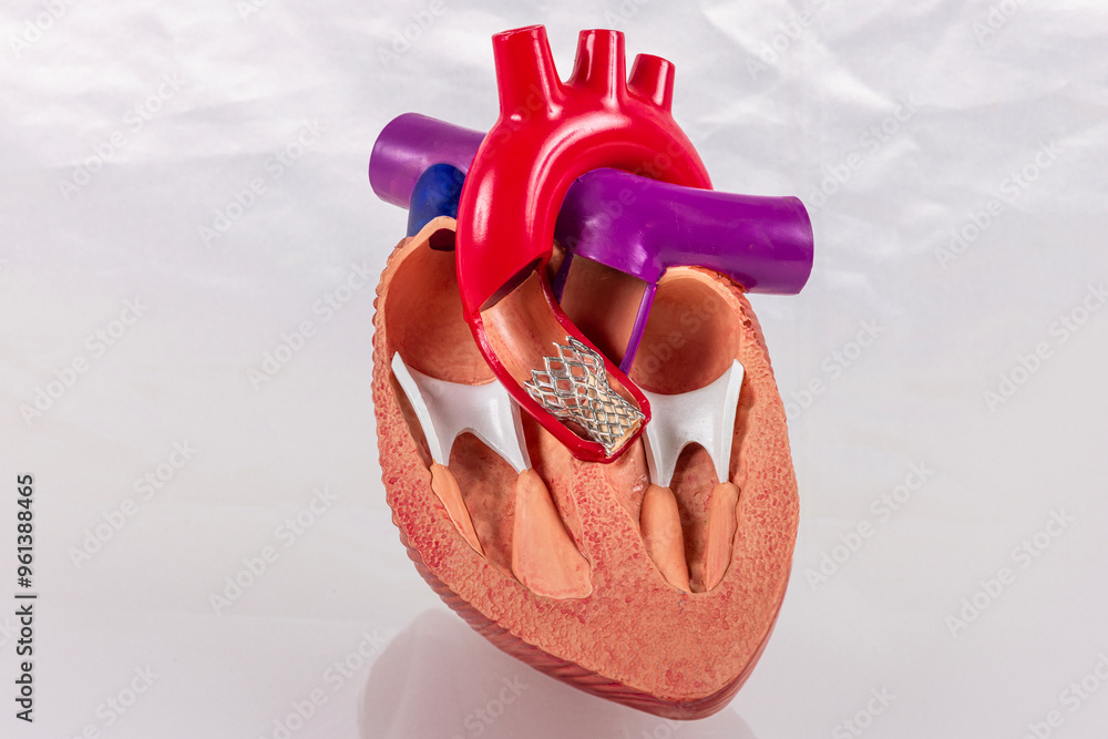 Cardiac model of Transcatheter aortic valve implantation (TAVI) for people education. Heart ...