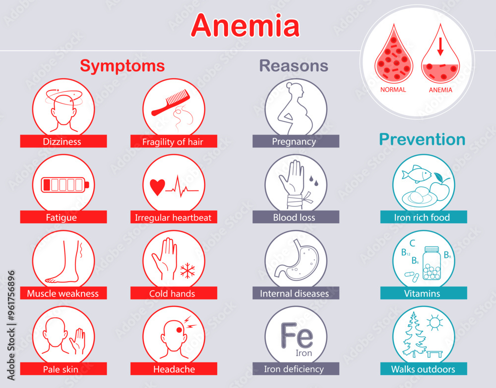 Infographic of anemia symptoms, reasons and prevention. Medical info ...