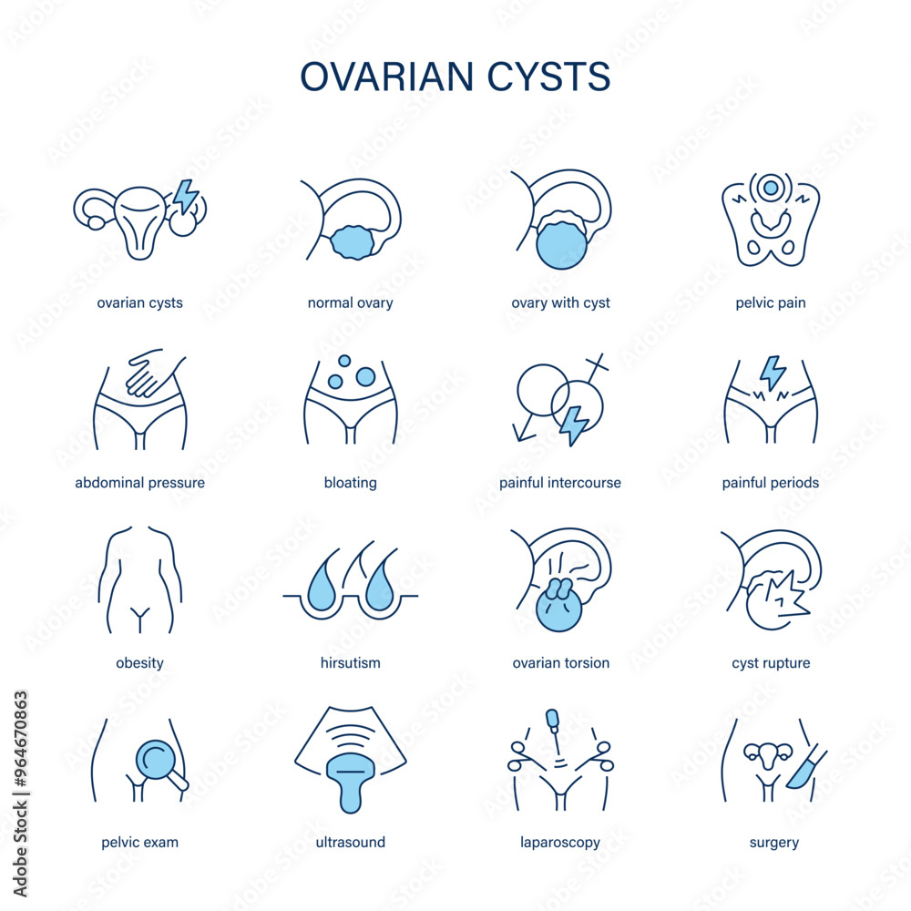 Ovarian Cysts symptoms, diagnostic and treatment vector icons. Medical ...