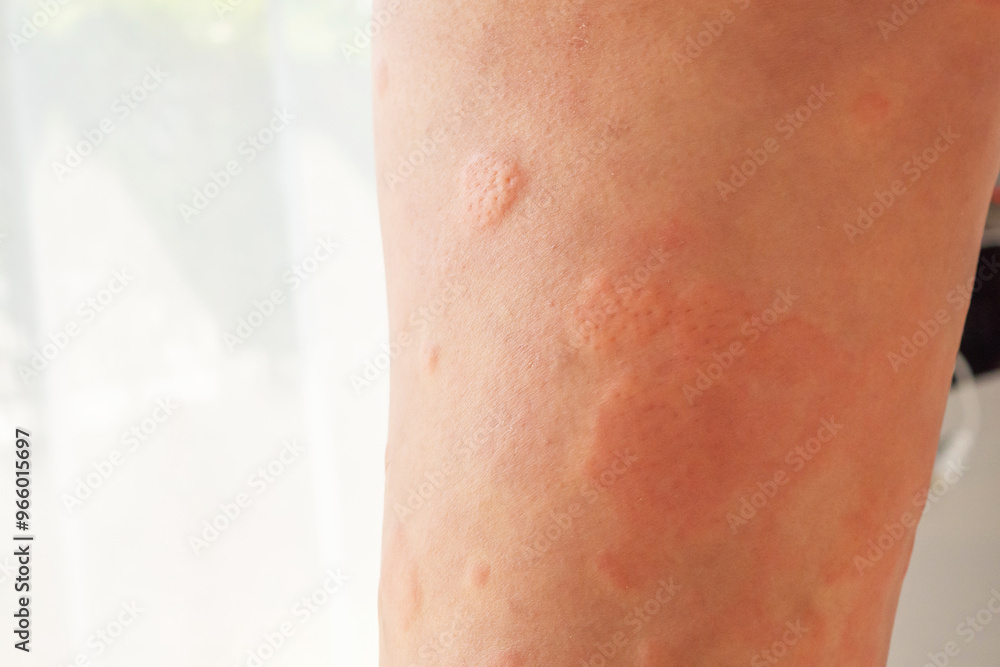 Young asian man has allergic skin rash on his legs from itchy dry skin ...