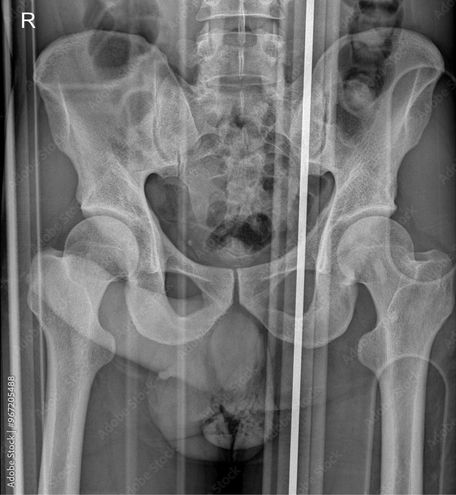 AP Pelvic Radiograph with Emphasis on Proximal Femur Anatomy Stock ...