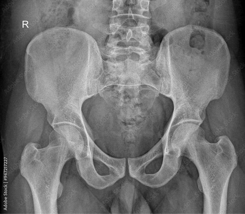 Anteroposterior Pelvis and Bilateral Proximal Femur X-ray: Diagnostic ...