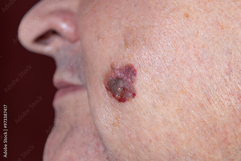 Foto de Stock Seborrheic keratosis (senile wart) skin growth on cheek ...