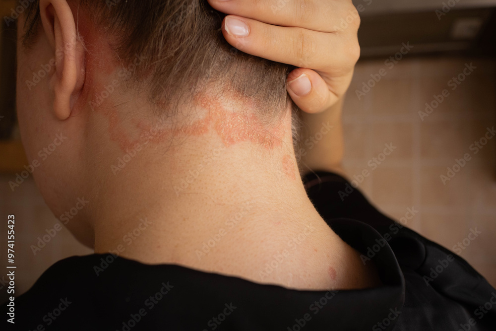Psoriasis. Psoriasis plaques on a girl’s head. Itching and. rash on the ...