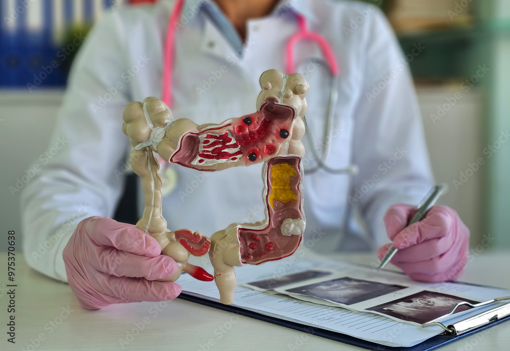 Intestine, appendix and digestive system, doctor holding anatomy model ...