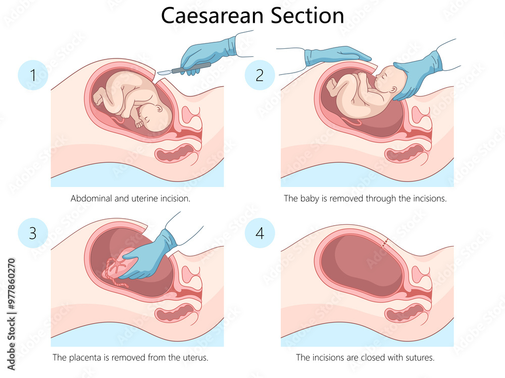 caesarean section procedure showing steps: incision, baby removal, placenta removal, suturing of ...