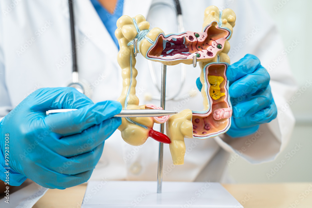 Ulcerative Colitis. Intestine, appendix and digestive system, doctor ...