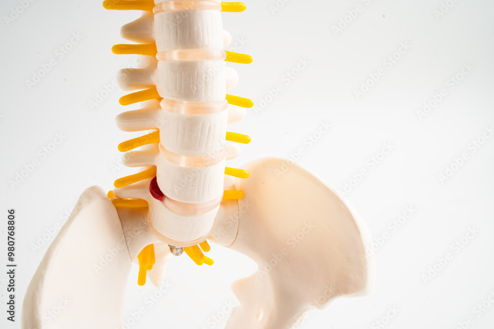 Lumbar spine displaced herniated disc fragment, spinal nerve and bone ...