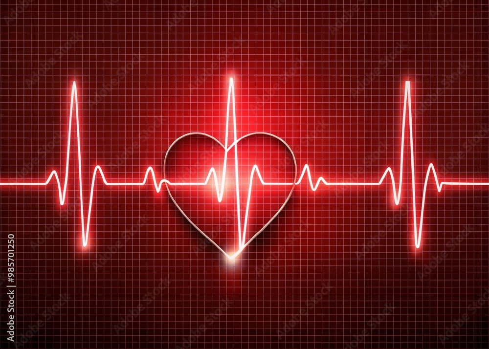 Heart monitor showing abnormal heart rhythm of atrial fibrillation with ...