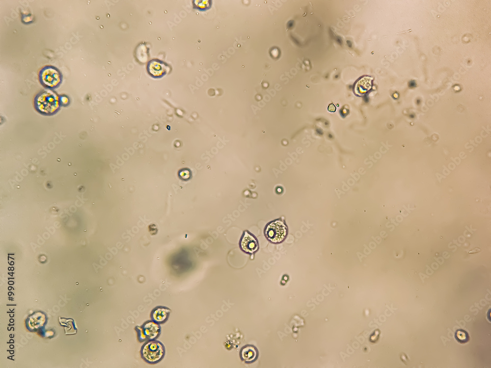 Trichomonas vaginalis in urine sediment analysed by microscope. It's a ...