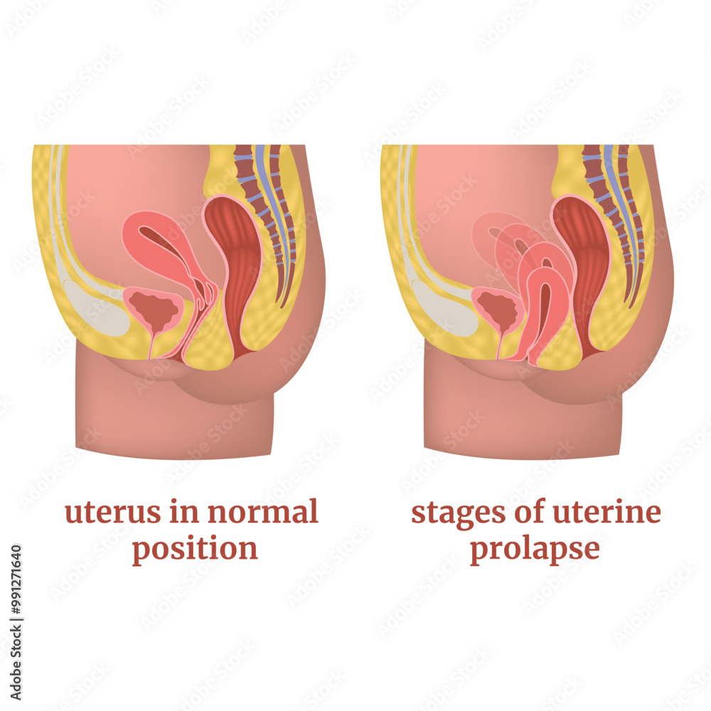 Stages of uterine prolapse. Diagram showing a cross-sectional view of a woman's body. Medical ...