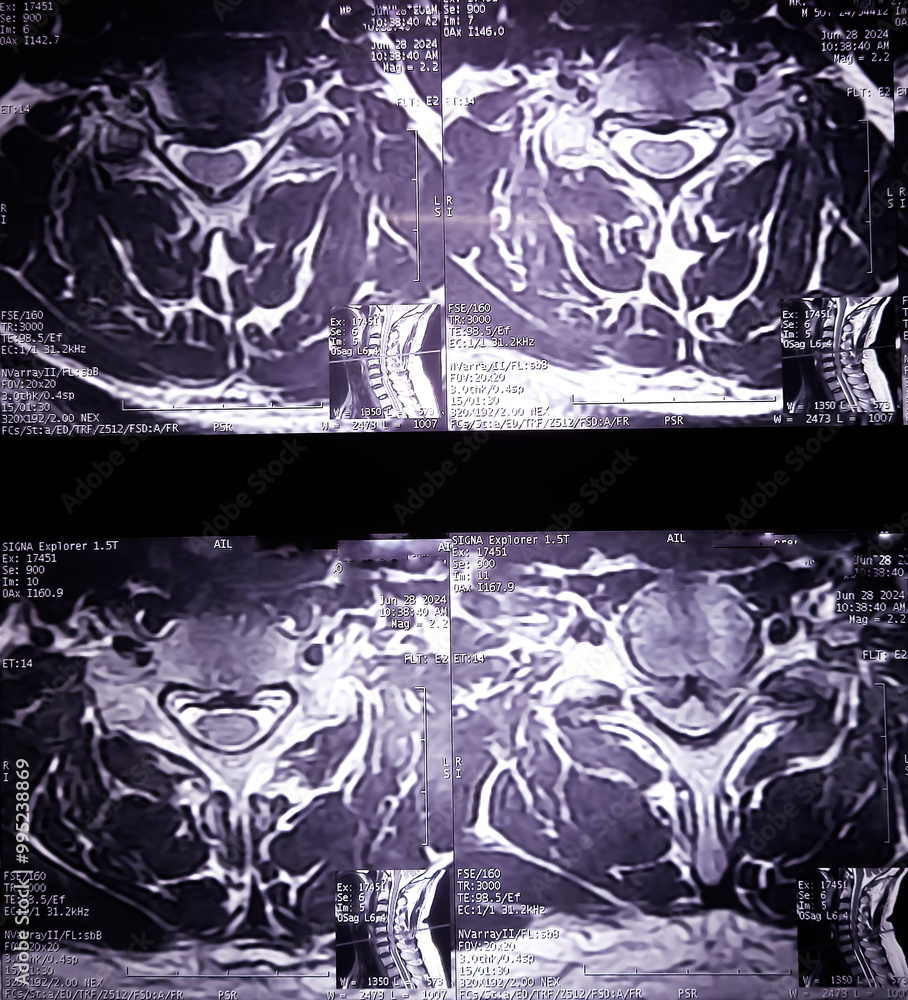 MRI scan of cervical spine (C-spine) : Nerve root compression and ...