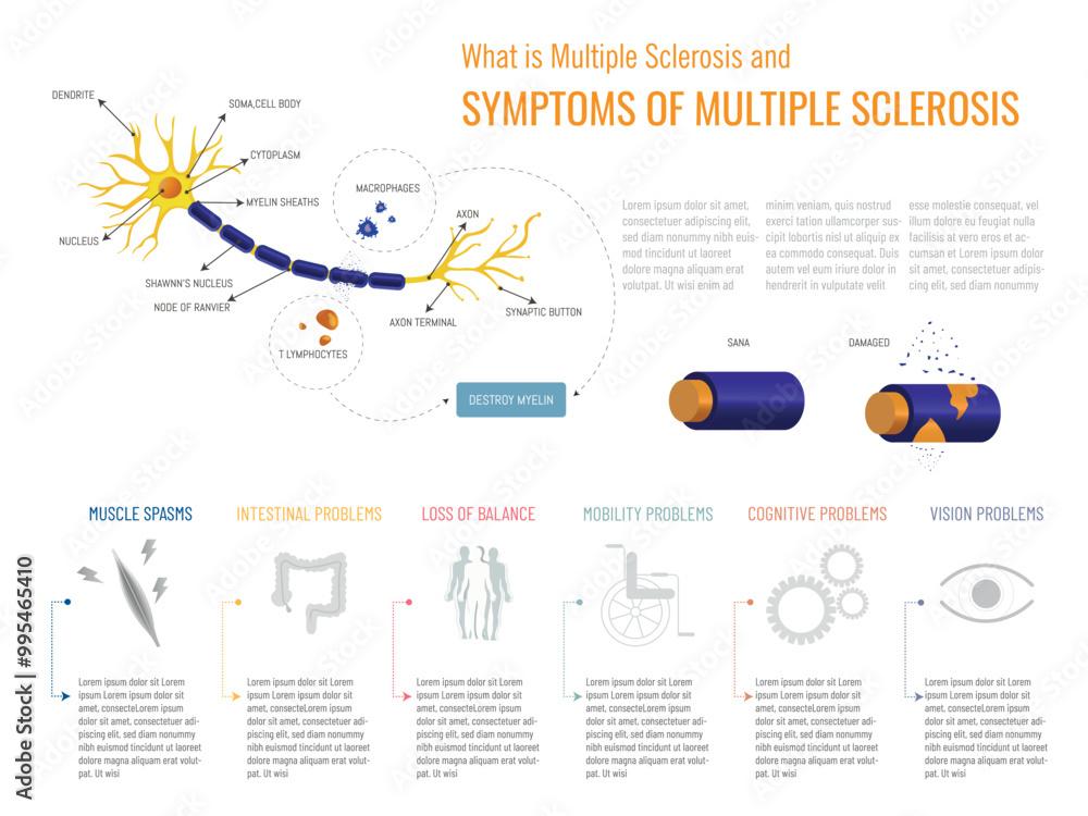 Educational infographic explaining what multiple sclerosis is ...