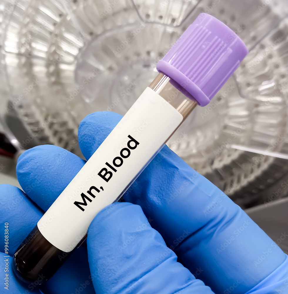 Blood sample for Manganese (Mn) test, to evaluate central nervous ...