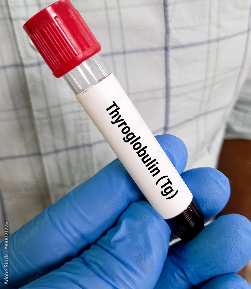 Blood sample for Thyroid Peroxidase Antibodies or Anti-TPO test and ...