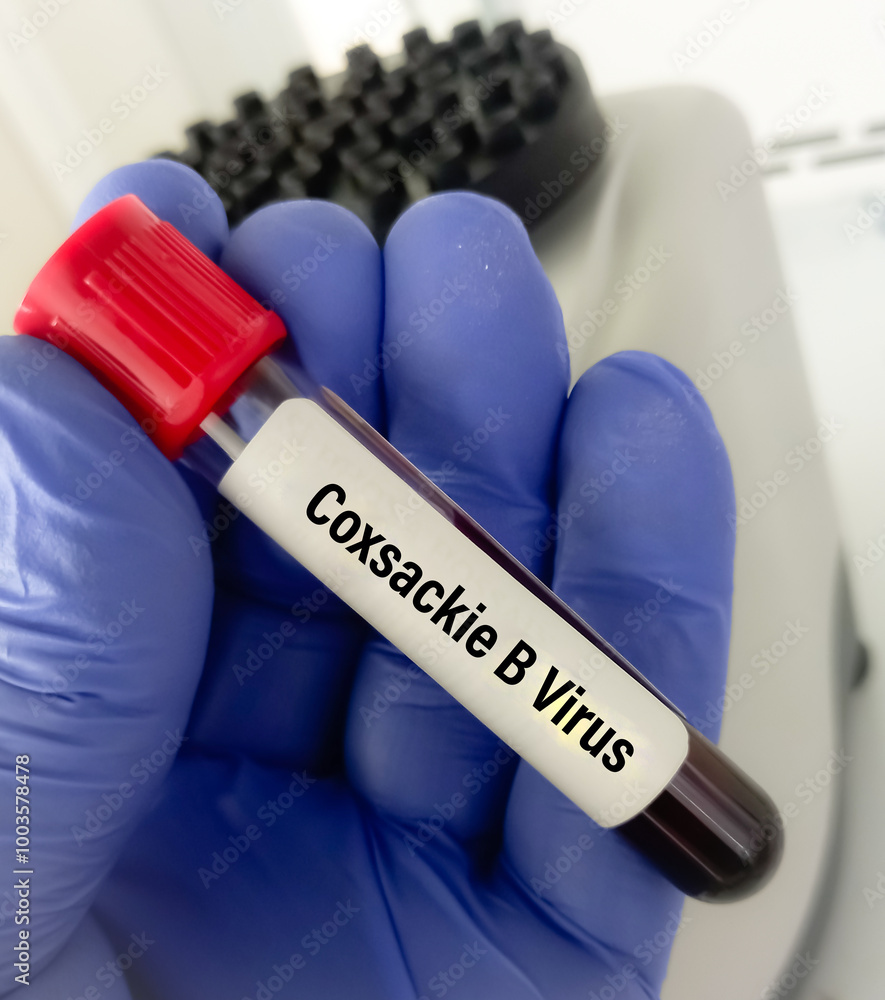 Blood sample for Hand foot and mouth disease (HFMD) test. It is a ...